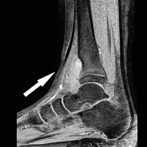 Sagittal View Of Right Lower Limb Mri Demonstrating An Abscess In The