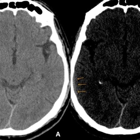 Axial Ct Image Of Brain Demonstrate Small Isodense Subacute Subdural Download Scientific