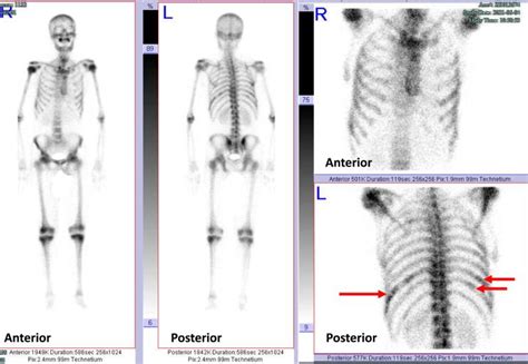 Non Poems Osteosclerotic Multiple Myeloma Clinical Characteristics And Differential Diagnosis Pmc