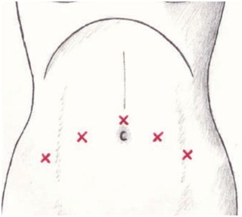 Robot Assisted Sacrohysterocolpopexy With Anterior And Posterior Mesh