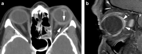 A 69 Year Old Female Inflammatory Scleritis On The Left Axial