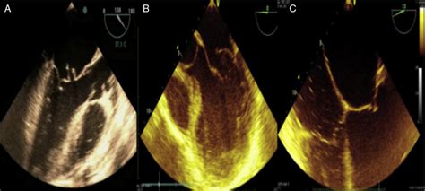 Carpentier Classification A Normal Motion B Excessive Motion C