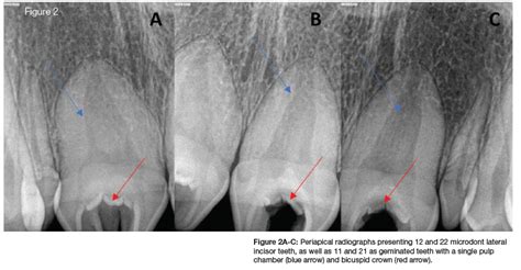 Bilateral Gemination