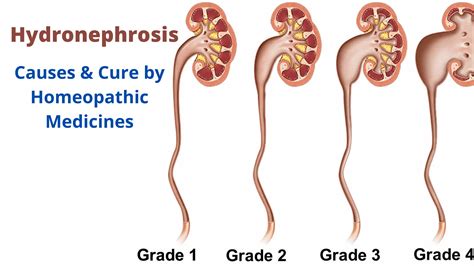 Grading System Hydronephrosis In Adults