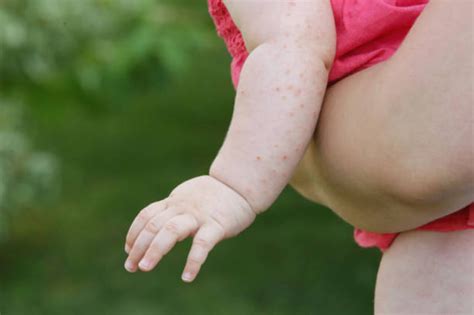 嬰幼兒熱疹是什麽？有何症狀？一次看懂嬰兒熱疹定義、治療及預防方法 柚子媽咪 Daily Life