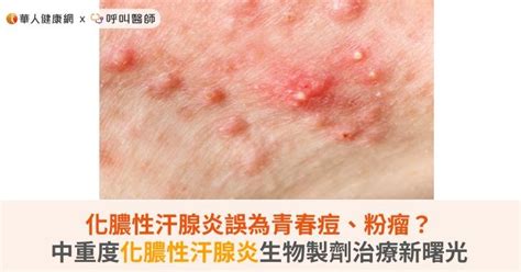化膿性汗腺炎誤為青春痘、粉瘤？中重度化膿性汗腺炎生物製劑治療新曙光 蕃新聞 醫療觀察站