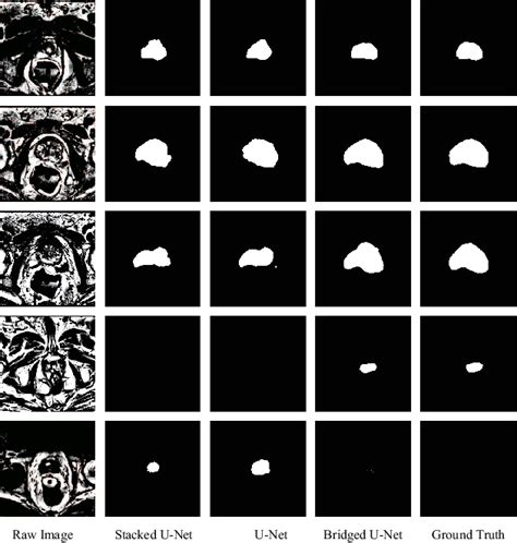 Figure 7 From Prostate Segmentation Using 2d Bridged U Net Semantic