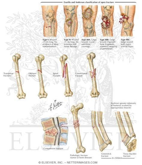 Gustilo And Anderson Classification Of Open Fracture