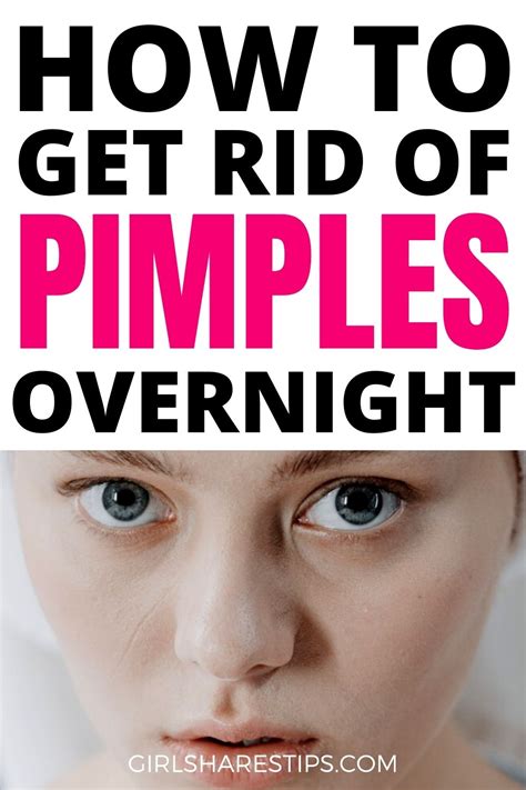 How To Get Rid Of Pimples Overnight Girl Shares Tips