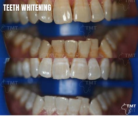 Tooth Whitening Before And After Stunning Transformations