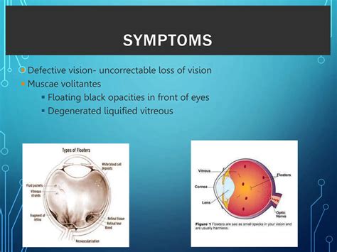 Myopia Basics Causes Types And Treatment Pptx