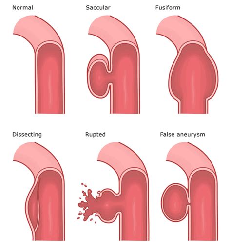 Types Of Brain Aneurysm Images Supreme Vascular And Interventional Clinic