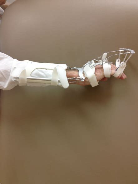 Dynamic Hand Splint Download Scientific Diagram