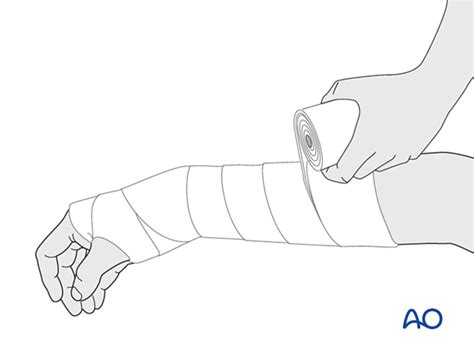 Nonoperative Treatment For Hamate Hook Fracture