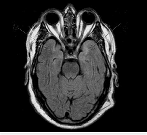 Brain Mri Axial Flair Showing Hyperintensities In The Anterior Temporal