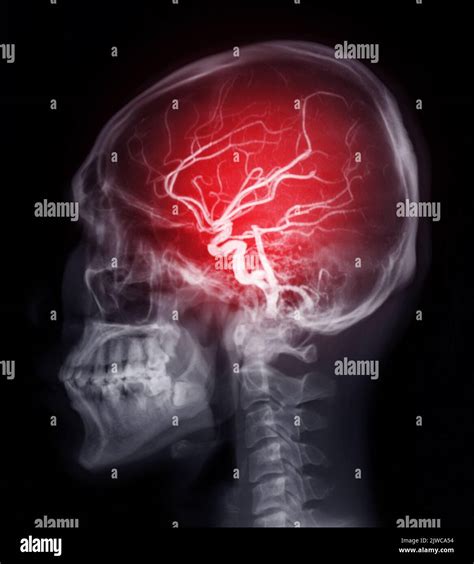Fusion De Limage Du Crâne Avec Mra Irm Cerveau Pour Les évaluer