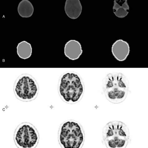 Pdf Application Of Siemens Smart Neuro Attenuation Correction In
