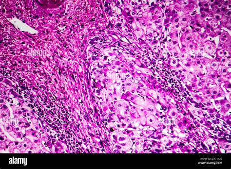 Histopathology Of Portal Liver Cirrhosis Light Micrograph Photo Under