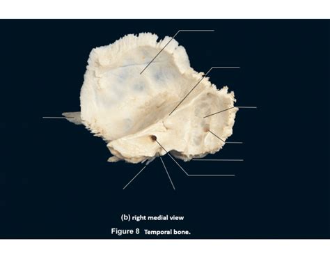 Temporal Bone Right Medial View Quiz