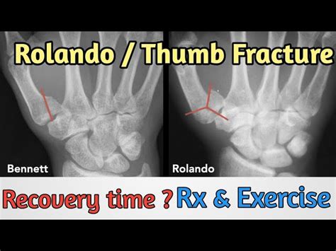Rolando Vs Bennett Fracture
