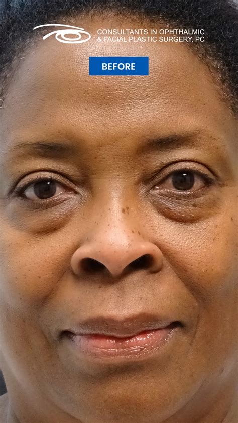 This Patient Received Excision Of Lower Eyelid Herniated Orbital Fat By Our One And Only Dr