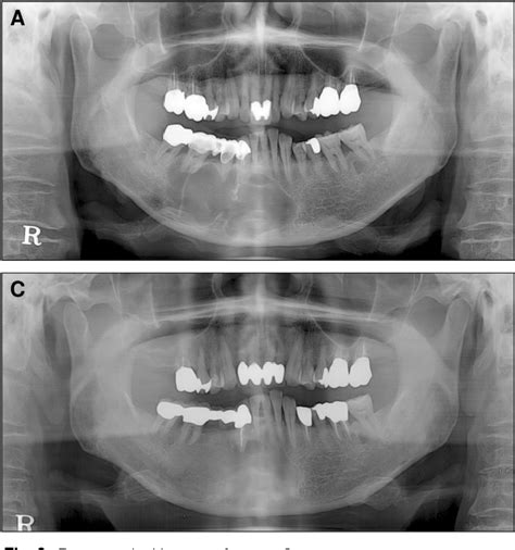 Figure 2 From Treatment Of Huge Mandibular Cyst With Enucleation After