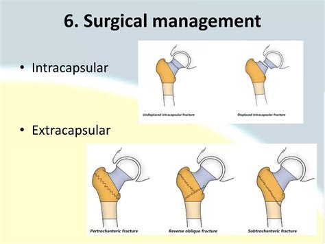 Hip Fracture Syndrome Pptx