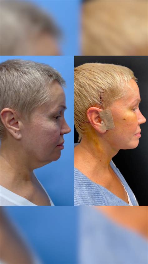 «Словно вернулась на 20 25 лет назад ️ Комплексная пластическая операция для нашей прекрасной