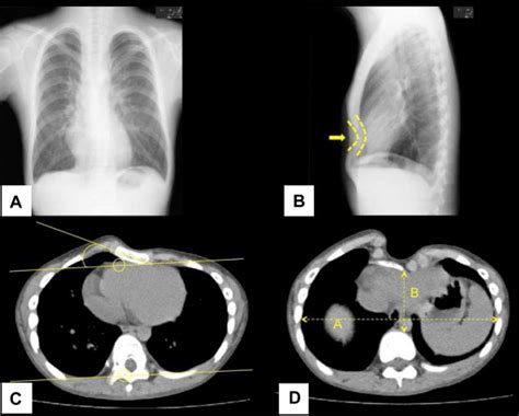 Chest X Ray Films A B And Chest Computed Tomography Scans C D