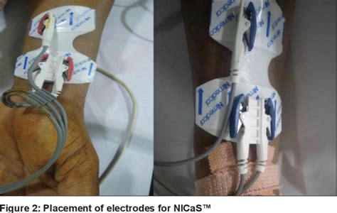 Figure 1 From Comparison Of Continuous Cardiac Output Monitoring Derived From Regional Impedance