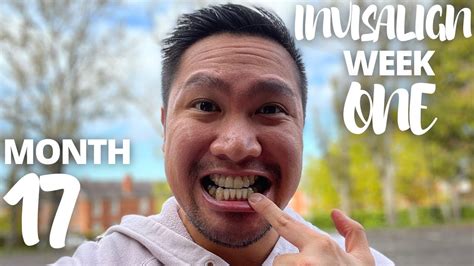 My First Week With Invisalign Month 17 Update And Initial Reactions