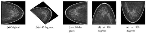 Sensors Free Full Text Computer Vision Based Microcalcification Detection In Digital