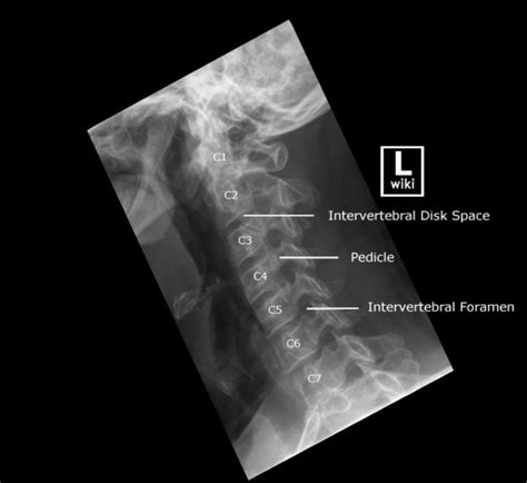 Cervical Spine Radiographic Anatomy Radiologypicscom