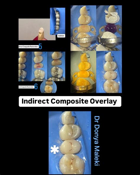 🦷 Maxillary Left Second Premolar Donya Maleki