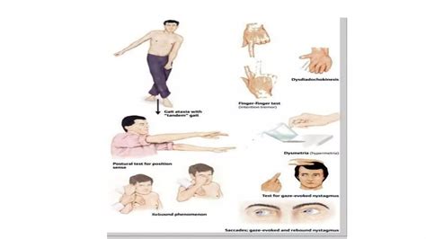 Cerebellar Diseases And Ataxia Pptx