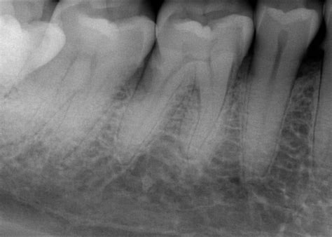 Dental Structure Detection Dataset And Pre Trained Model By Dental