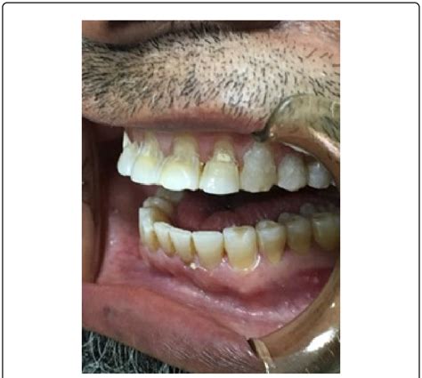 Generalized Cervical Non Carious Lesion An Elderly Patient Exhibiting Download Scientific