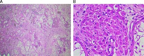 A Testicular Parenchyma Widely Remodeled By Fibrosis With Increased