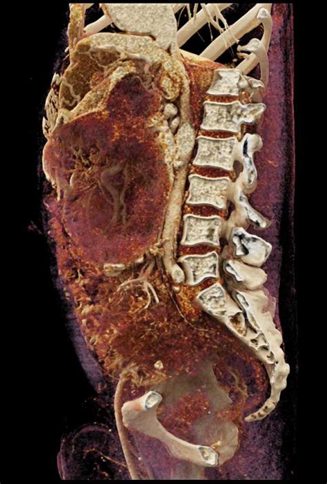 Ulcerating Gastric Gist Tumor Stomach Radiology Case Studies Ctisus