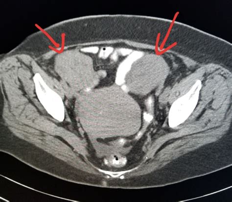 Abdomen Ct Bilateral Enlarged Ovaries From Metastatic Disease