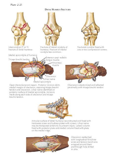 Fracture Of Distal Humerus In Medical Knowledge Upper Arm Bone Anatomy