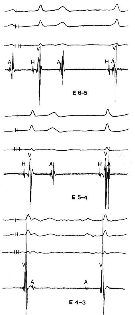 Atrial A His Bundle H And Ventricular V Activation