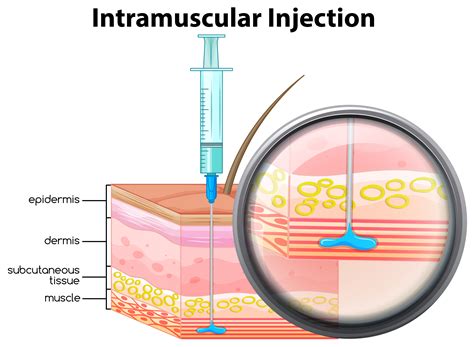 Human Skin Intramuscular Injection 433484 Vector Art At Vecteezy