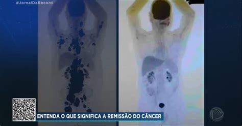 Dispara A Procura Por Terapia Experimental Que Tem Levado à Remissão Do