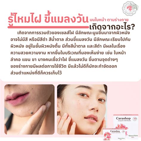 ครีมกำจัดไฝ ขี้แมลงวัน กระ ติ่งเนื้อ