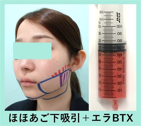 Womの基本術式『 ほほあご脂肪吸引 ＋エラボトックス 』だけここまで変わる！！ Womクリニック銀座