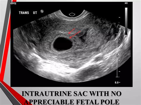 Ectopic Pregnancy Radiology Ppt