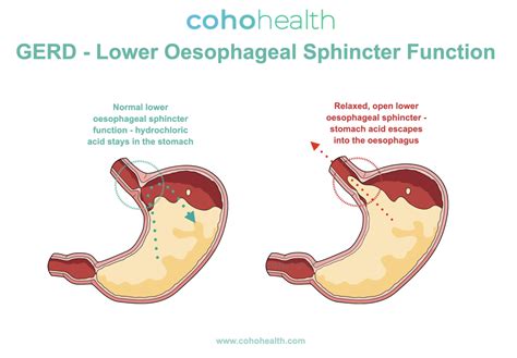 The Functional Medicine Approach To Gerd Feel Better Faster