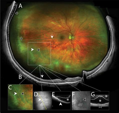 广域光学相干断层扫描和血管造影的临床应用：叙述性回顾ophthalmology And Therapy X Mol