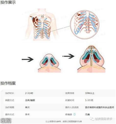 肋软骨隆鼻多少钱？ 蜜颜优惠